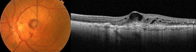 Age Related Macular Degeneration - Retina & Eye Consultants