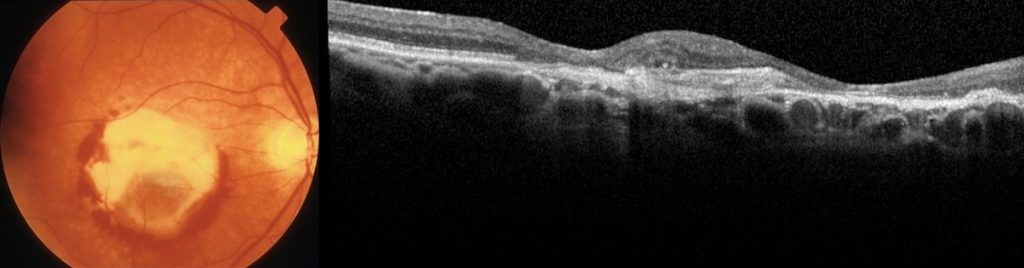 Age Related Macular Degeneration - Retina & Eye Consultants