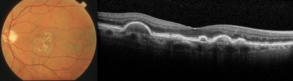 Age Related Macular Degeneration - Retina & Eye Consultants