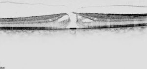 Full Thickness Macular Holes - Retina & Eye Consultants